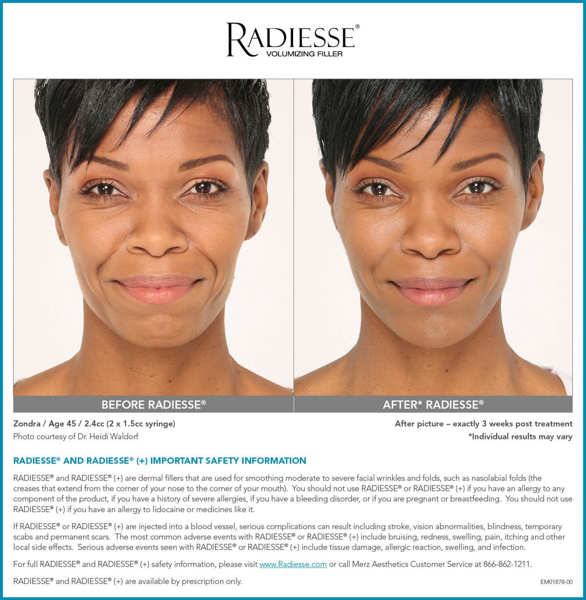 Radiesse/Radiesse Plus - Heidelberg Dermatology